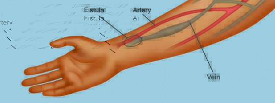 Types of Kidney Dialysis Access | Fistulas - Catheters - Grafts